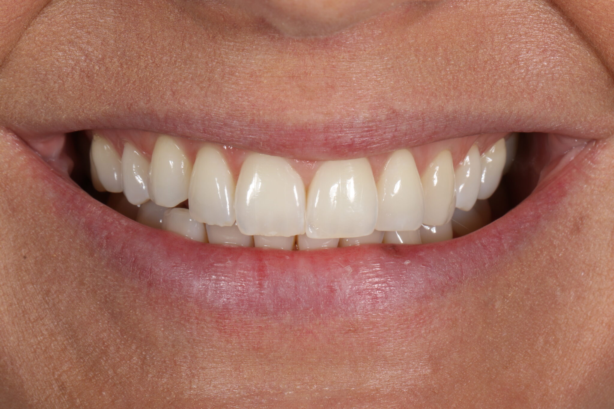 Composite Bonding Manchester | Tooth Bonding in Manchester | Ringway Dental