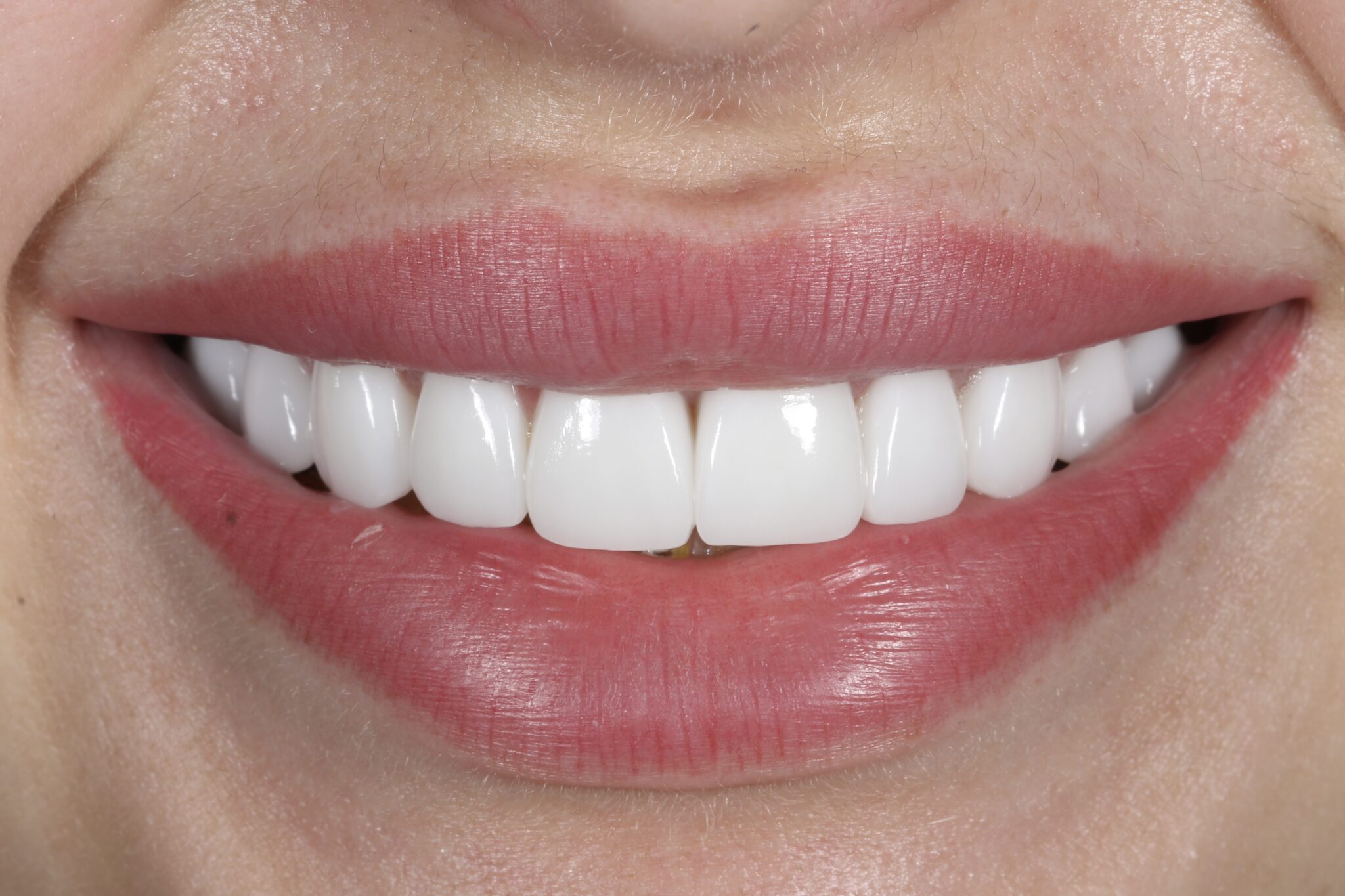 Smile Makeovers In Manchester | Ringway Dental