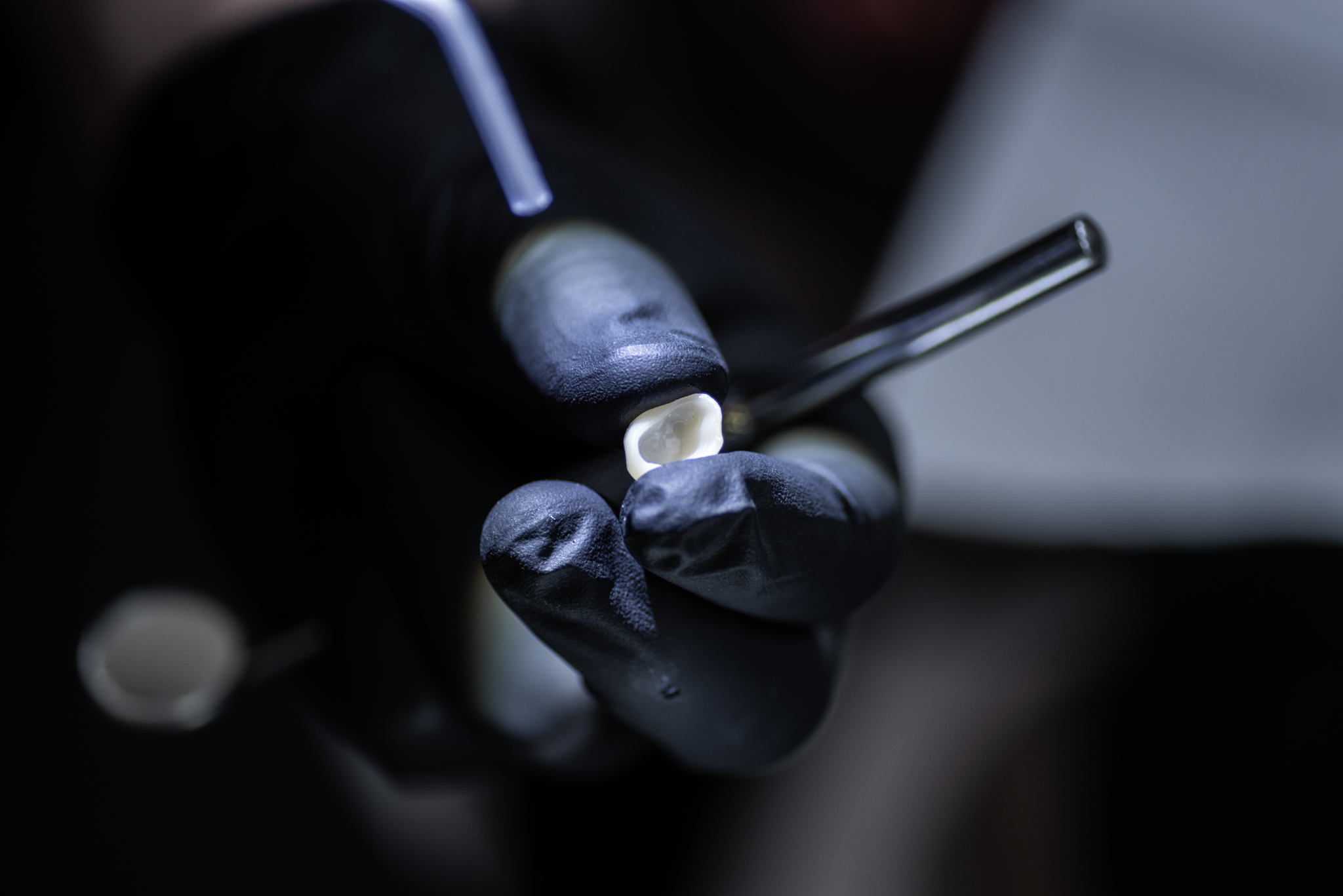 Can I Glue a Chipped Tooth Back Together? | Ringway Dental